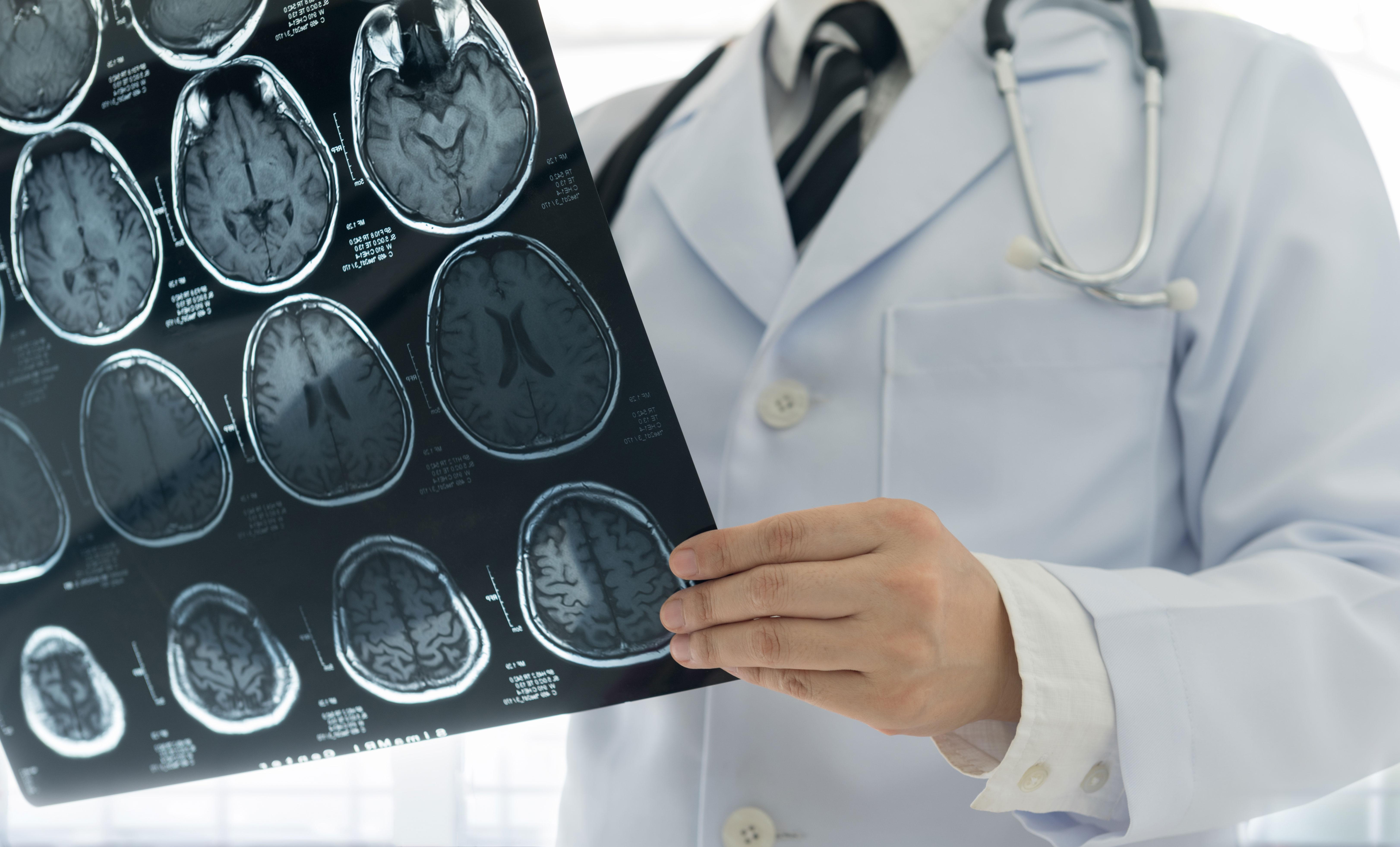 A doctor looking over a MRI scan of a brain